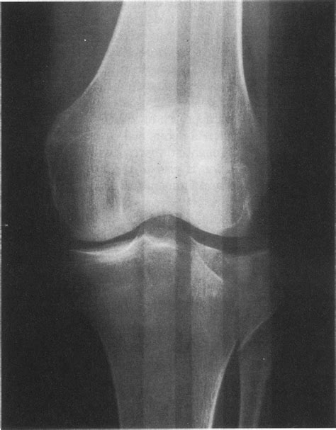 A Example Of Split Compression Fracture Meniscal Tears And Ligamentous