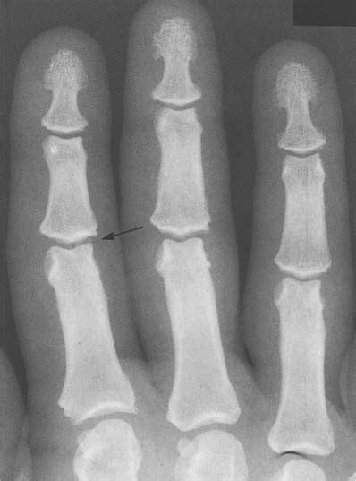 Joint And Soft Tissue Calcification Musculoskeletal Key
