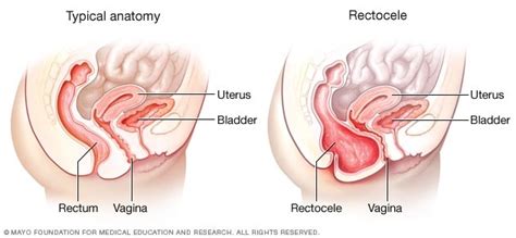 Posterior Vaginal Prolapse Rectocele Symptoms And Causes Mayo Clinic
