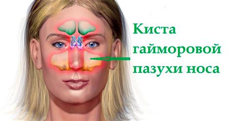 Почему развивается и чем опасна киста гайморовой пазухи