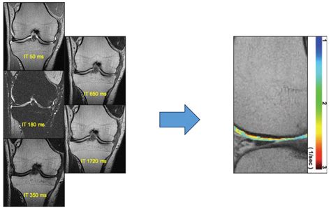 Advanced Mr Imaging For Knee Osteoarthritis A Review On Local And Brain Effects