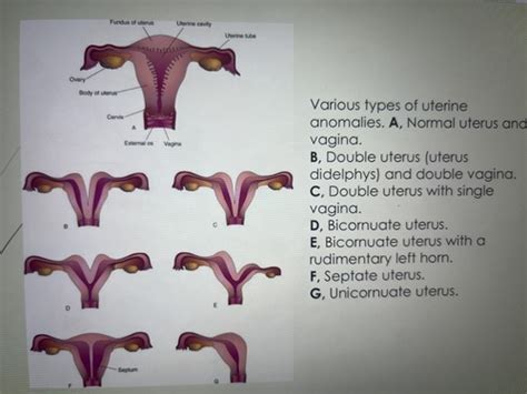 Congential And Structural Defects Of The Female Reproductive Tract Flashcards Quizlet