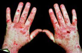 Skin Disorder All About Agent Orange