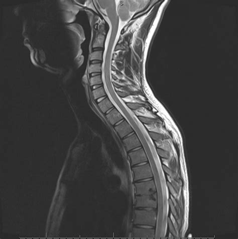 Spinal Fusion Radiology