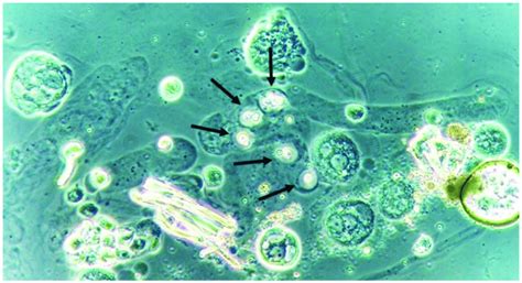 Cryptococcus Neoformans Encapsuled Yeasts Within A Urinary Cast Fresh Download Scientific