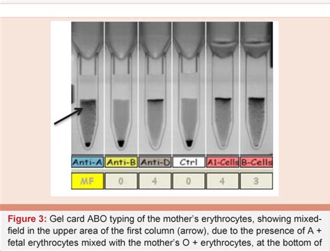 Figure 1 From A Case Of Severe Silent Fetomaternal Haemorrhage Fmh Detected By Mixed Field In