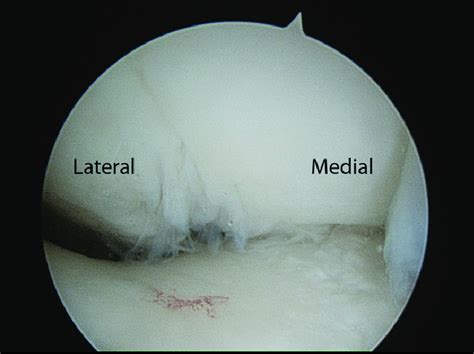 Arthroscopic View Showing Medial Tilt And Medial Patellar Facet