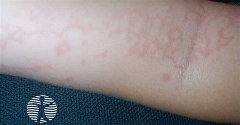 Erythema Infectiosum Image