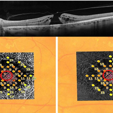 A The B Scan Oct Shows A Full Thickness Macular Hole B The Central