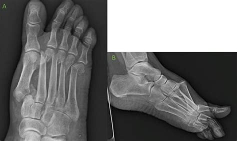 Ossiofiber® Orif Of 1st Tmt Fracturedislocation And 2 5 Metatarsal Fractures