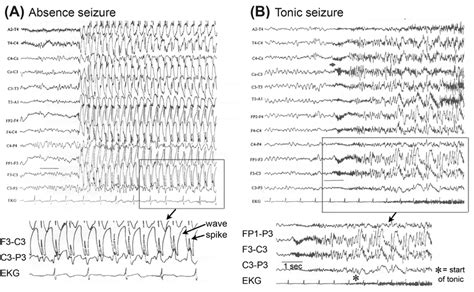 1 The Use Of Electroencephalography Eeg To Distinguish Types Of Download Scientific Diagram