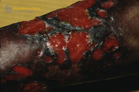 Numerous Discrete Coalescing Ulcers With Surrounding Hyperpigmented