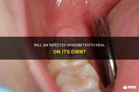 Will An Infected Wisdom Tooth Heal On Its Own Medshun