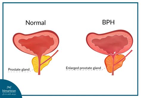 Erectile Dysfunction After Prostate Treatment Key Solutions