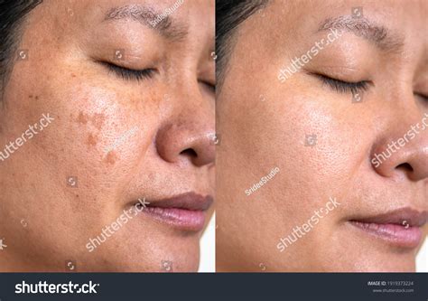 Hyperpigmentation Face Before And After