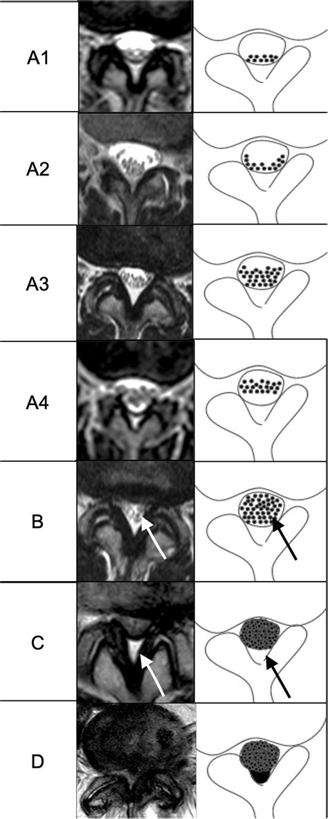 Lumbar Spinal Stenosis Mri Grading