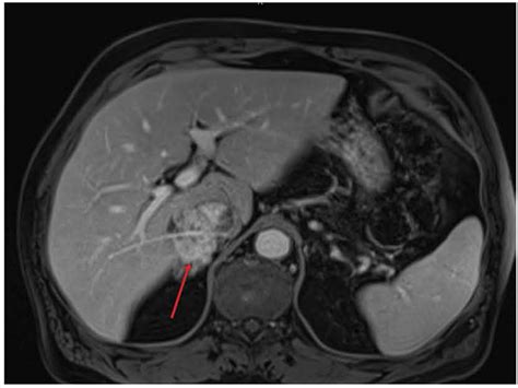 Pre Operative Mri Showing Involvement Of The Retro Hepatic Ivc By Download Scientific Diagram