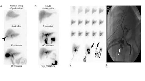 Causes Of Biliary Strictures And Its Management Pptx