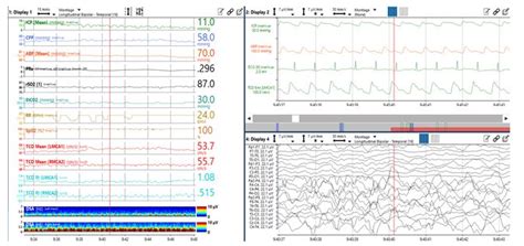 The Emerging Role Of Multimodality Neurologic Monitoring In Pediatric Neurocritical Care