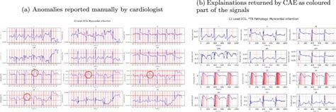 A Convolutional Autoencoder Framework For Ecg Signal Analysis Heliyon