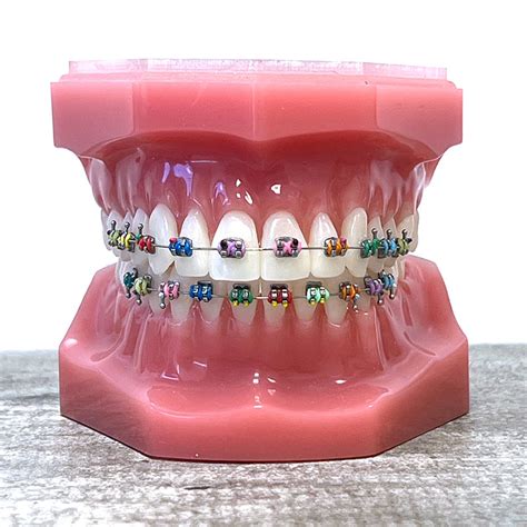 Traditional Braces Glendale Orthodontics