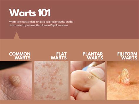Flat Warts Causes Warts How To Identify Causes Types Treatment