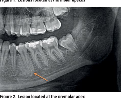 Figure 2 From Idiopathic Osteosclerosis And Condensing Osteitis In A