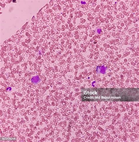 Photomicrograph Of Hematological Slide Showing Rbc Wbc And Platelet