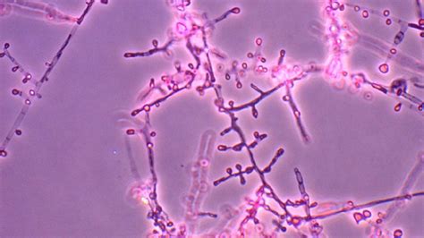 First Cases Of Drug Resistant Trichophyton Indotineae Tinea Ringworm Fungus In The United