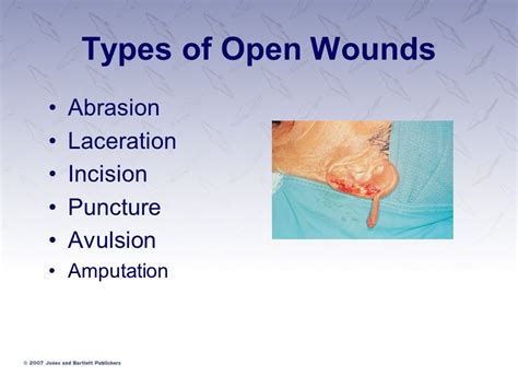 Types Of Open Wounds