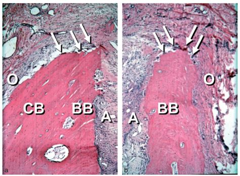 Bone Loss And The Fate Of A Tooth Extraction Teeth And Titanium