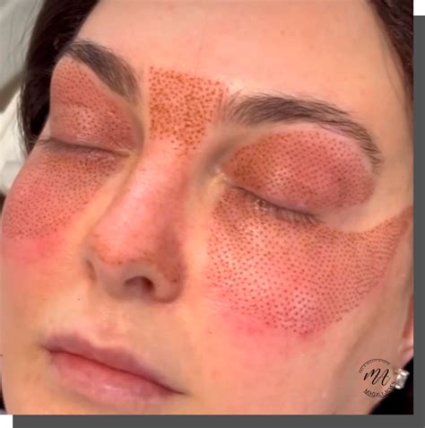 Fibroblast Magali Alves Beauty Studio