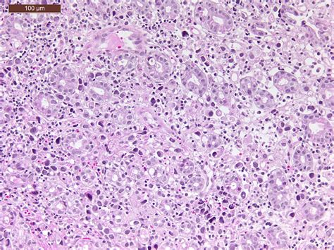 Pathology Outlines Diffuse Poorly Cohesive Type Adenocarcinoma