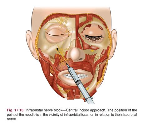 Infraorbital Nerve Block Landmarks