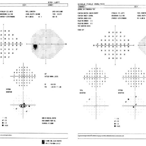 visual field testing revealed two moderate paracentral defects od and