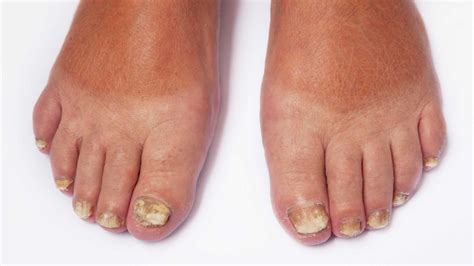 Athletes Foot Fungal Infection Is Not Limited To Just Athletes