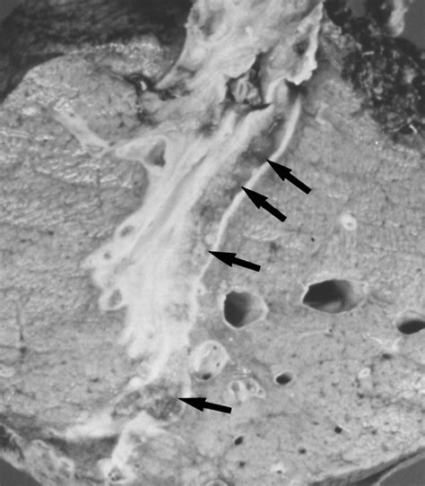 Ct Features Of Intraductal Intrahepatic Cholangiocarcinoma Ajr