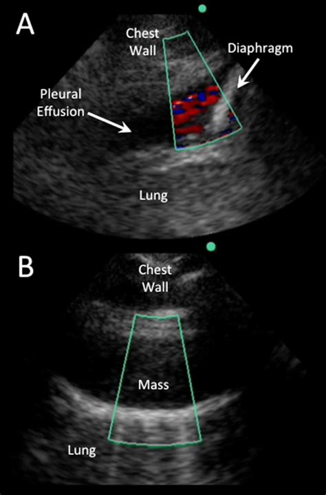 Ultrasound And Pleural Effusions Mdedge