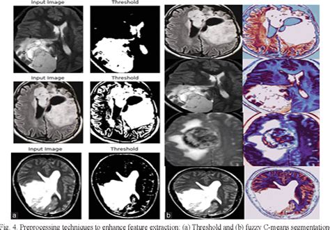 Figure 4 From Brain Tumor Segmentation Using Enhancement Convolved And