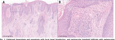 Figure 1 From Hyperpigmentation In An Elderly Patient With Atopic