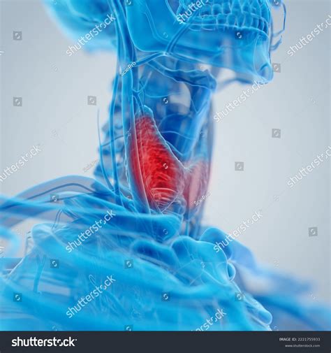 3d Rendered Medical Illustration Inflamed Thyroid Stock Illustration