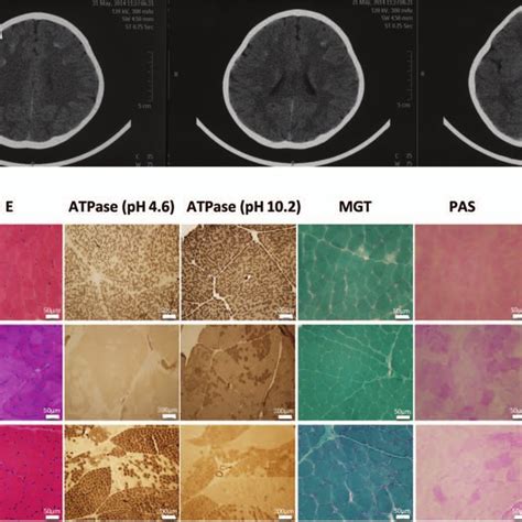 A The Brain Computed Tomography Scan Of Patient 1 Shows Download Scientific Diagram
