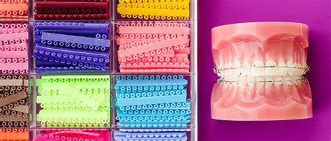 Braces Rubber Bands What They Are And What They Do Healthrow Net