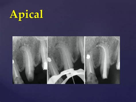 Curved And Dilacerated Canals Pptx