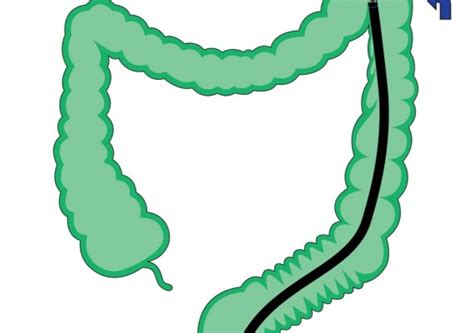 The Passing Of Splenic Flexure Colon Explorer