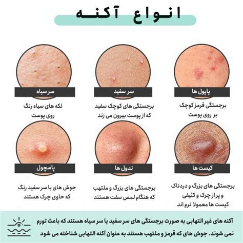 انواع مختلف جوشهای پوستی