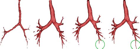 Segmentation Of An Airway Tree Comparison Of Different Segmentation