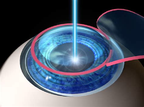 What Is Laser Eye Surgery Lasik Eye Surgery Hawaii Laser Eye