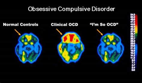Ocd Brain