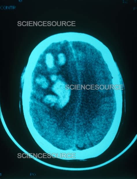 Photograph Brain Hemorrhage Ct Scan Science Source Images